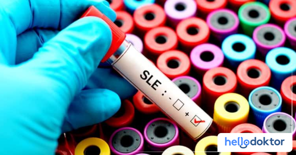 Diet Untuk Lupus, Ada Pantang Larang Pemakanan Buat Pesakit SLE