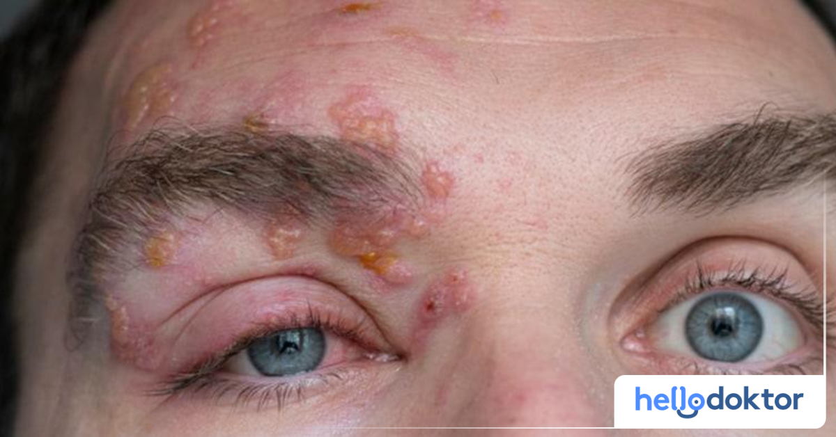 Apa Itu Kayap? Ini Penerangan Ringkas Berkenaan Dengan Penyakit Ini