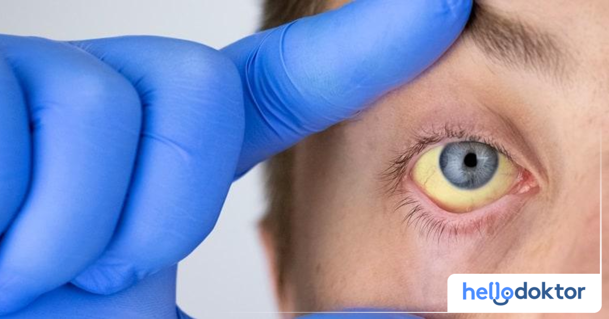 Apa Itu Hepatitis? Ini ABC Hepatitis Yang Anda Perlu Tahu! - Hello Doktor