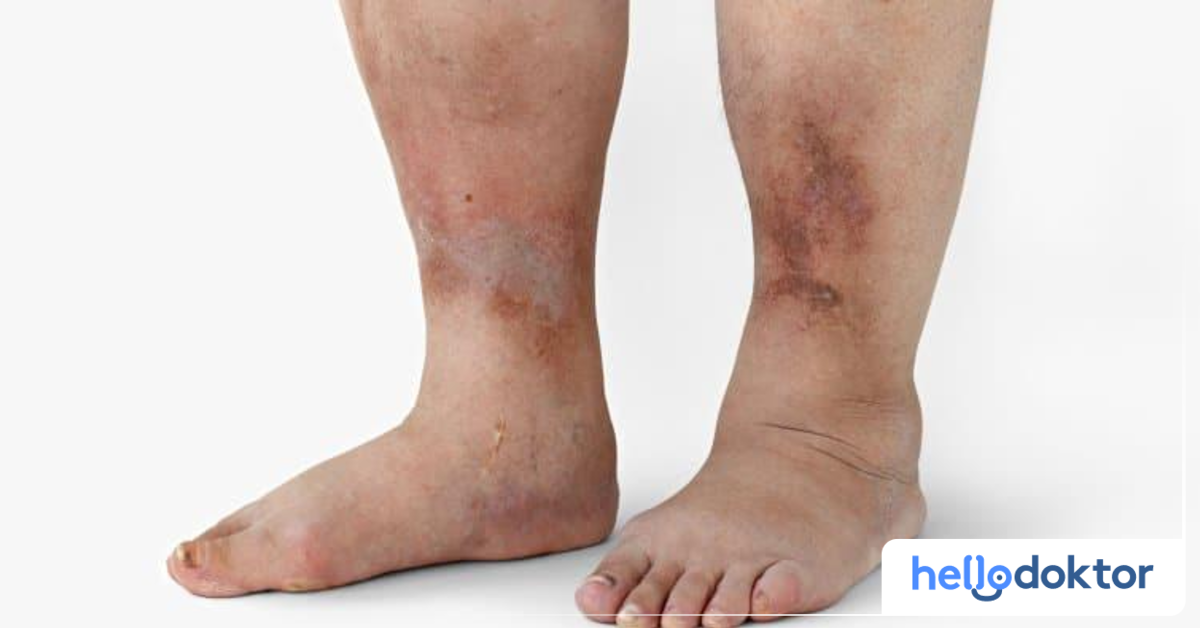 Kaki Bengkak Diabetes: Ini Punca & Cara Untuk Surutkan Bengkak!