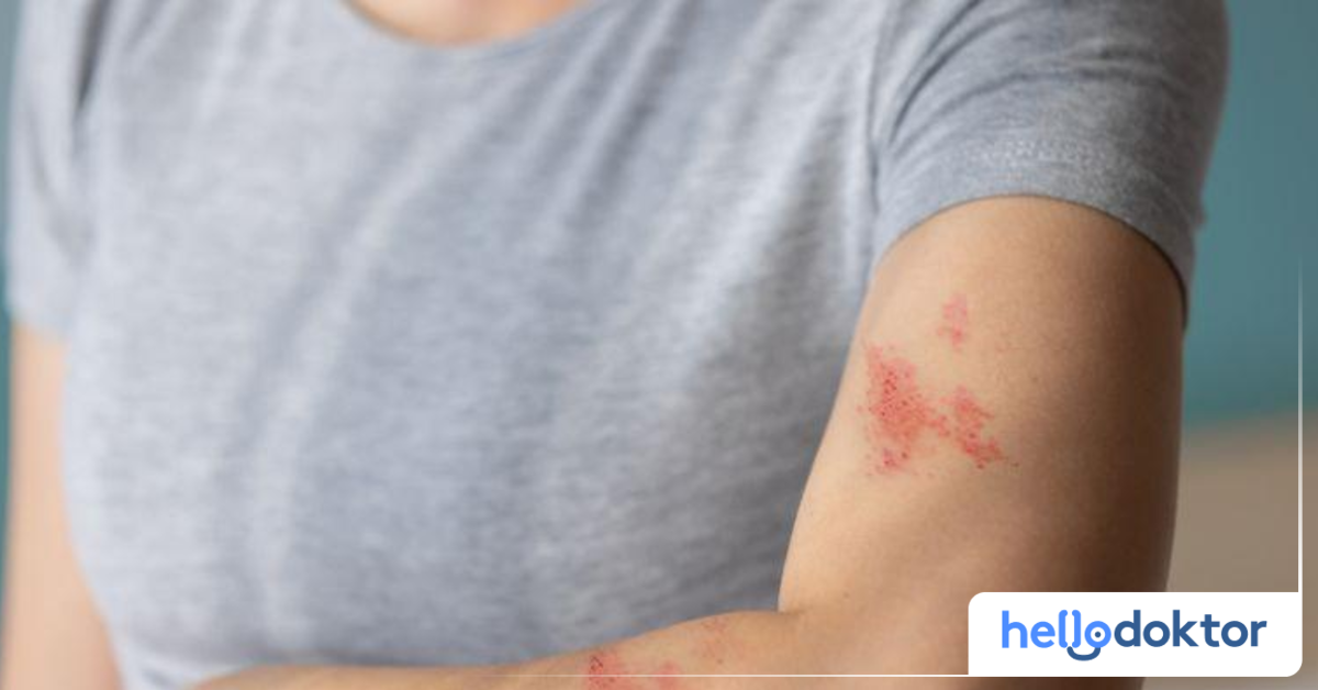 Kesan Kayap, Chickenpox & Sindrom Ramsay Hunt Akibat Virus Herpes!