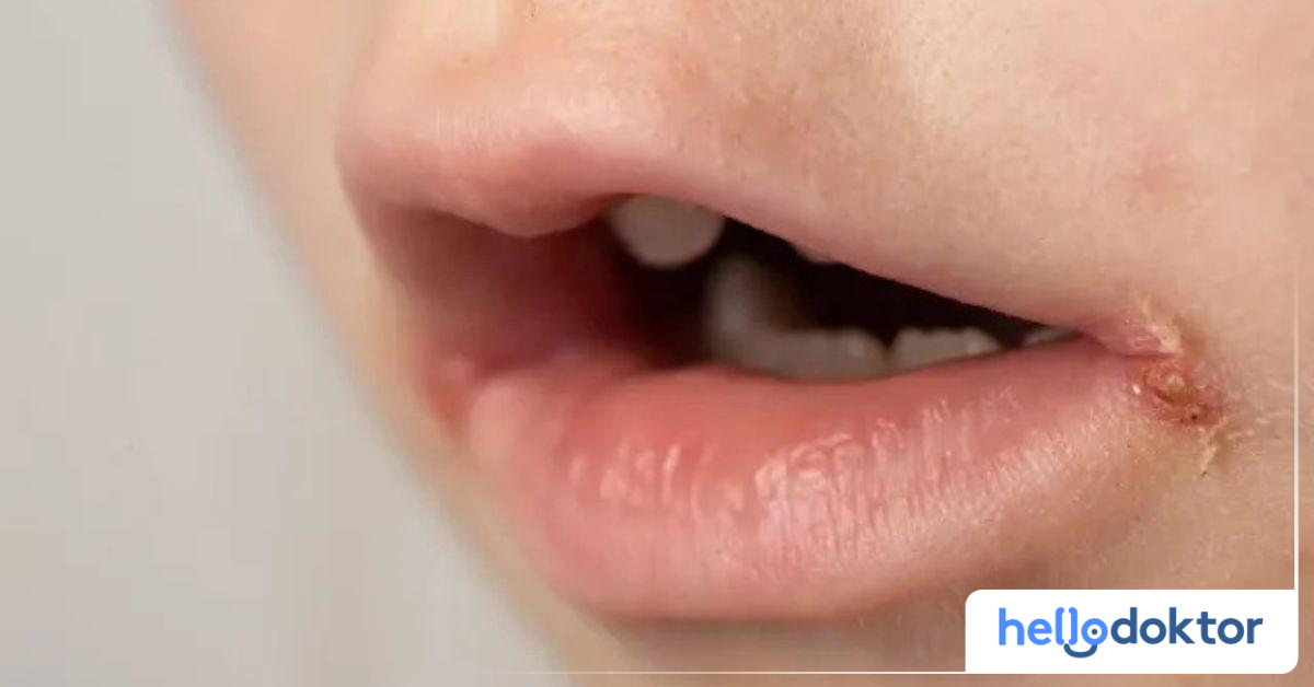 Bibir Pecah Dan Kering Mungkin Petanda Penyakit Cheilitis? Jaga-jaga!
