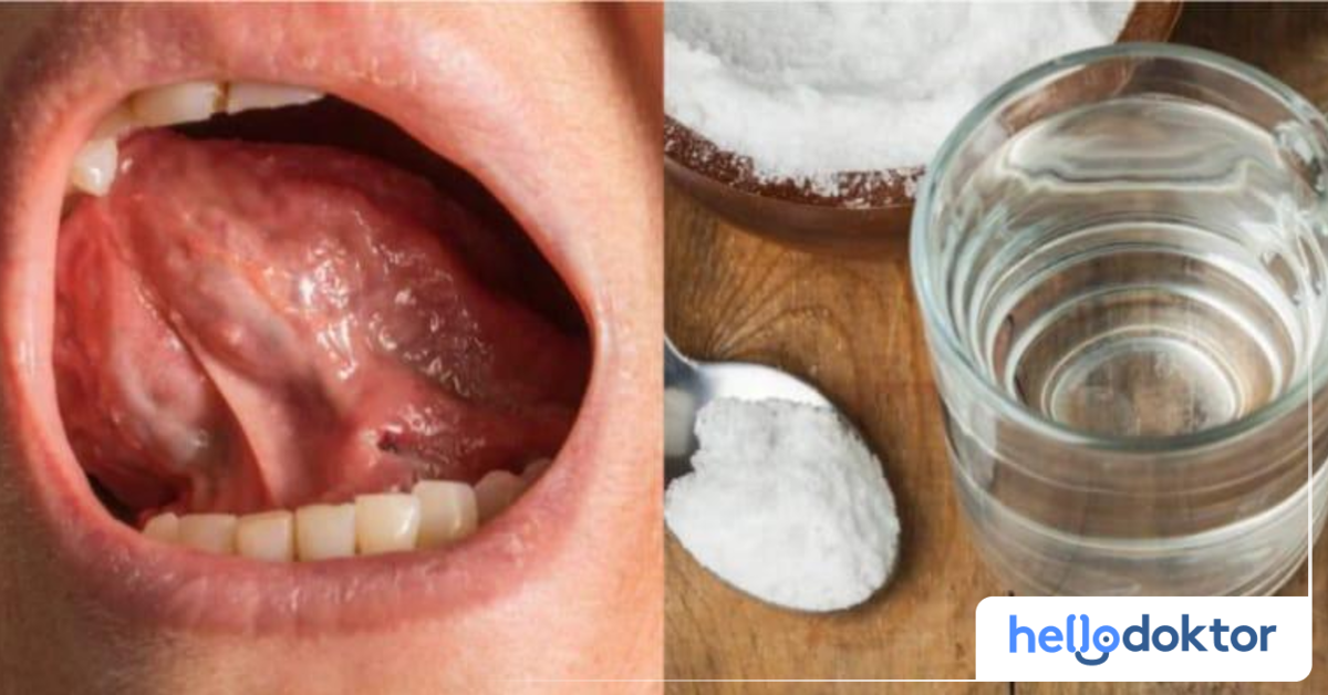 Ubat Ulser Lidah, Kalau Tak Berjaya Cara Moden, Ayuh Cuba 6 Petua Ini!