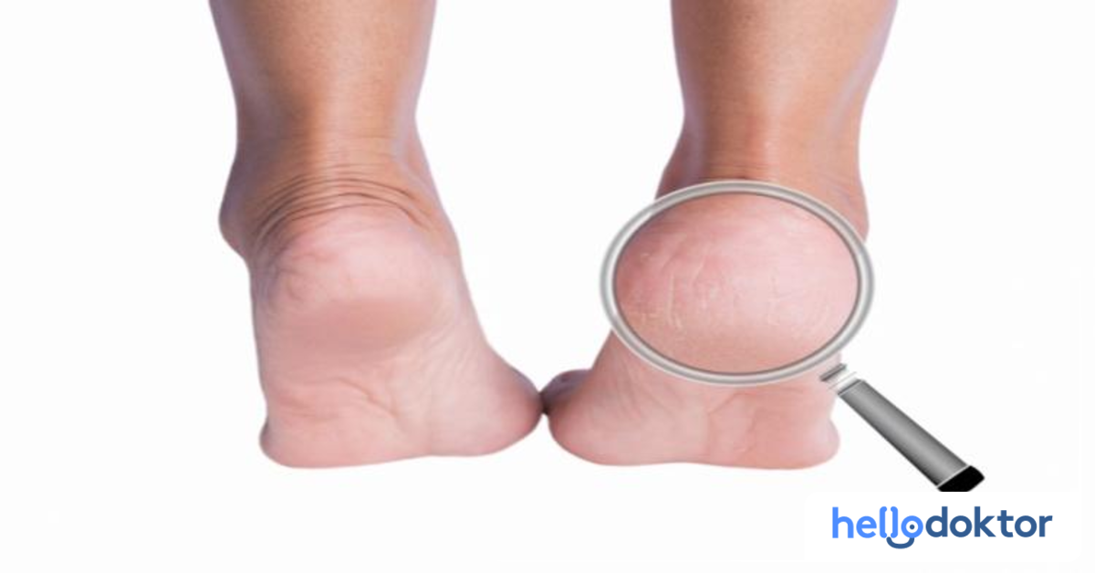 Kulit Kaki Kering Dan Gatal, Ini 5 Cara Mudah Untuk Atasinya!