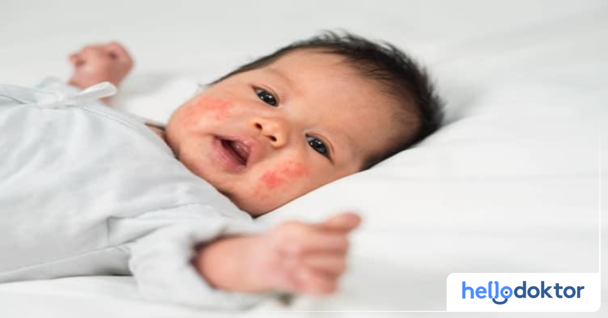 Cara Hilangkan Ruam Di Muka Bayi Dengan 7 Petua Semula Jadi