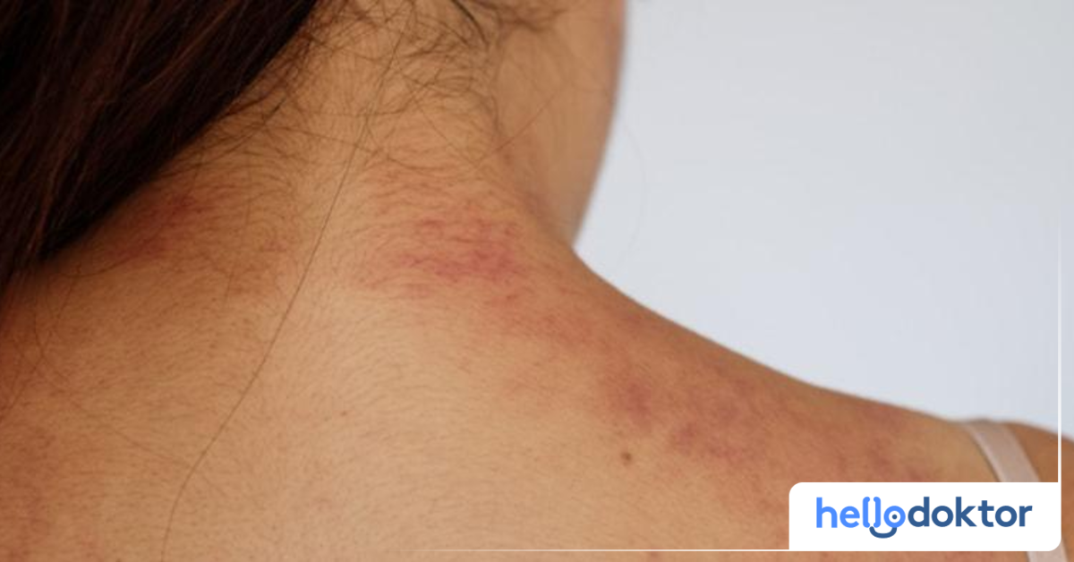 Tanda Alergik Ubat, Apa Simptom Yang Boleh Dikenal Pasti?