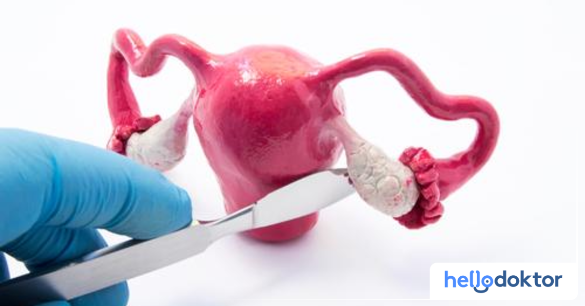 Ooforektomi: Prosedur Pembedahan Pembuangan Ovari : Definisi, Faktor ...